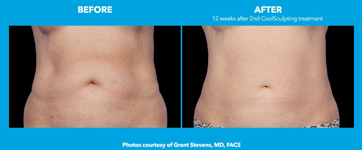 CoolSculpting Before and After